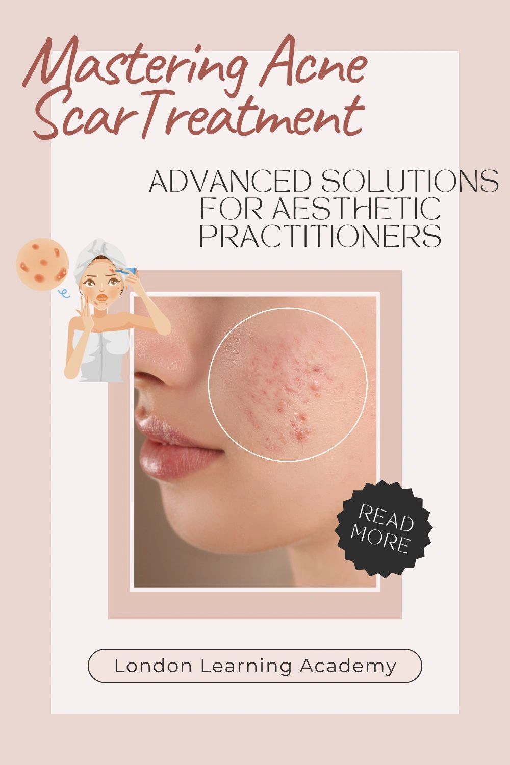 Mastering Acne Scar Treatment: For Aesthetic Practitioners
